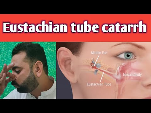 Eustachian Tube Dysfunction Causes Symptoms And Treatment How To Treat